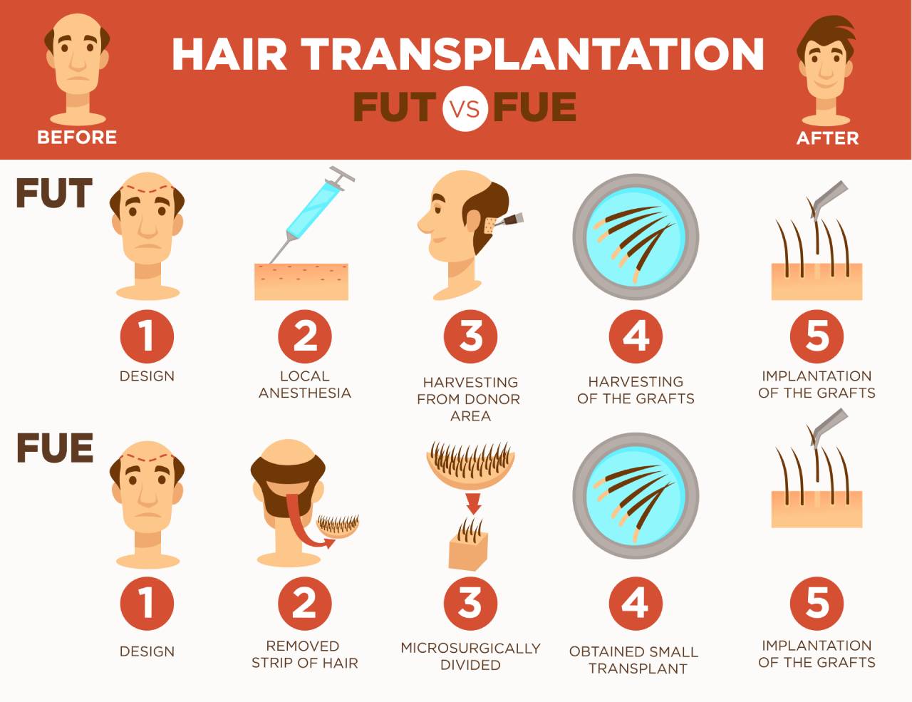 FUE Vs. FUT: Which Hair Transplant Method Is Better? - Viral Rang